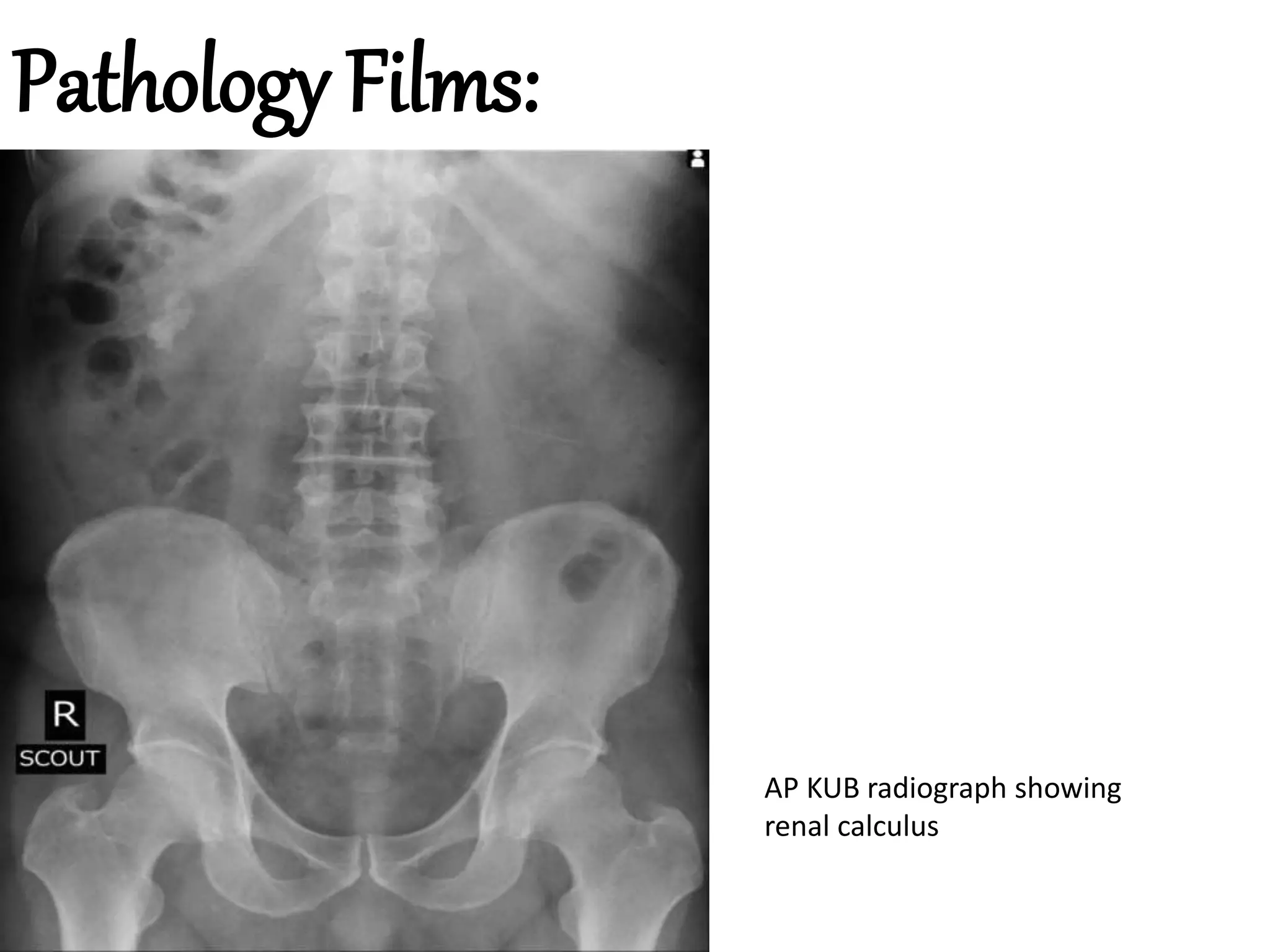 Radiological importance of intravenous pyelography | PPTX
