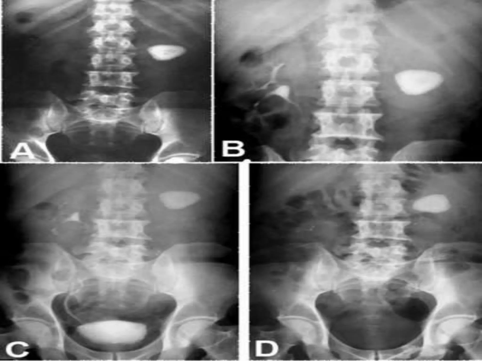 Radiological importance of intravenous pyelography | PPTX