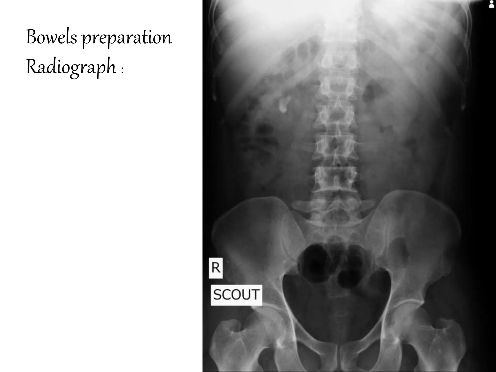 Radiological importance of intravenous pyelography | PPTX