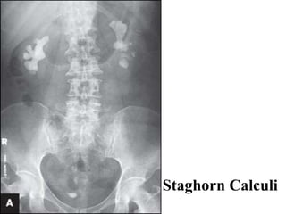 Radiological importance of intravenous pyelography | PPTX