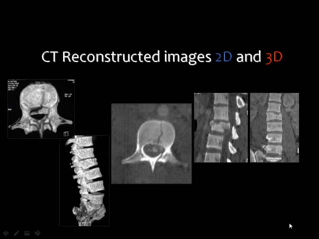 Radiological Investigations of spinal Trauma.pptx | Death, Injury, or ...