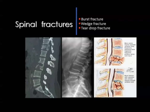 Radiological Investigations of spinal Trauma.pptx | Death, Injury, or ...
