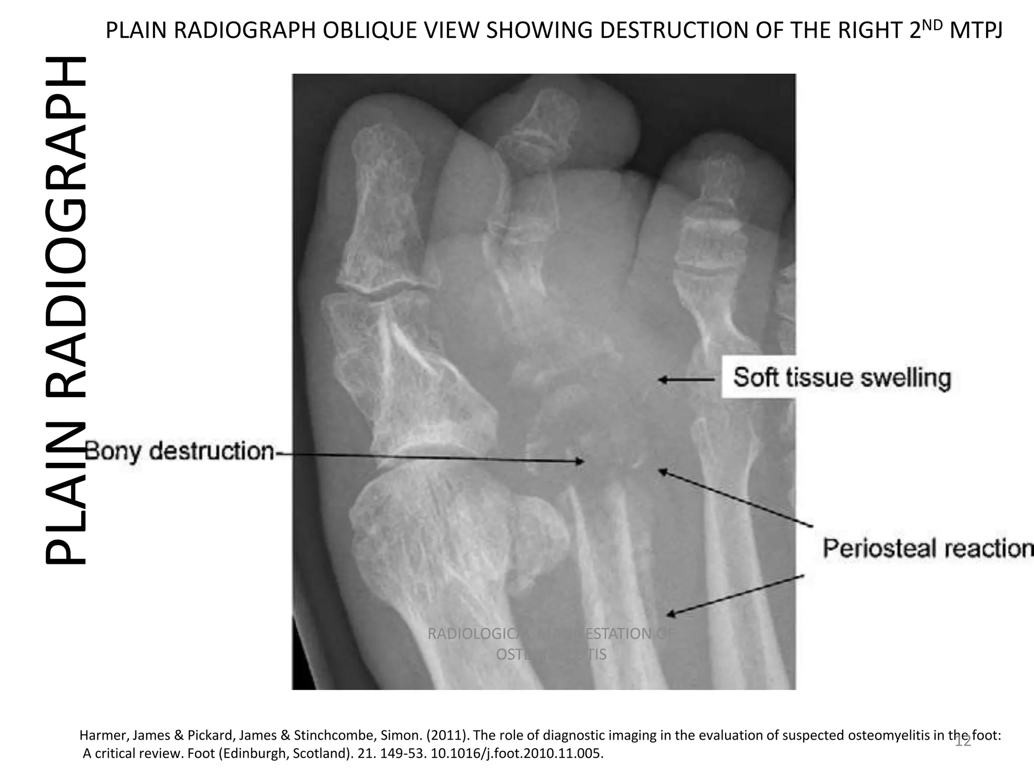 Radiological manifestations of chronic osteomyelitis - Dr. Olanipekun ...