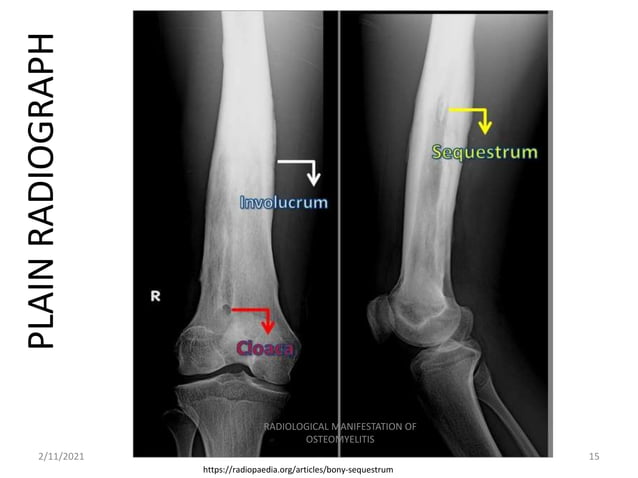 Radiological manifestations of chronic osteomyelitis - Dr. Olanipekun ...