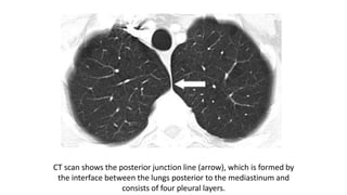 Radiological mapping of mediastinum.pptx