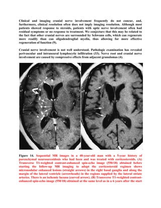 Topic of the month: Radiological pathology of neurosarcoidosis | PDF