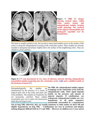 Topic of the month: Radiological pathology of tuberous sclerosis | PDF