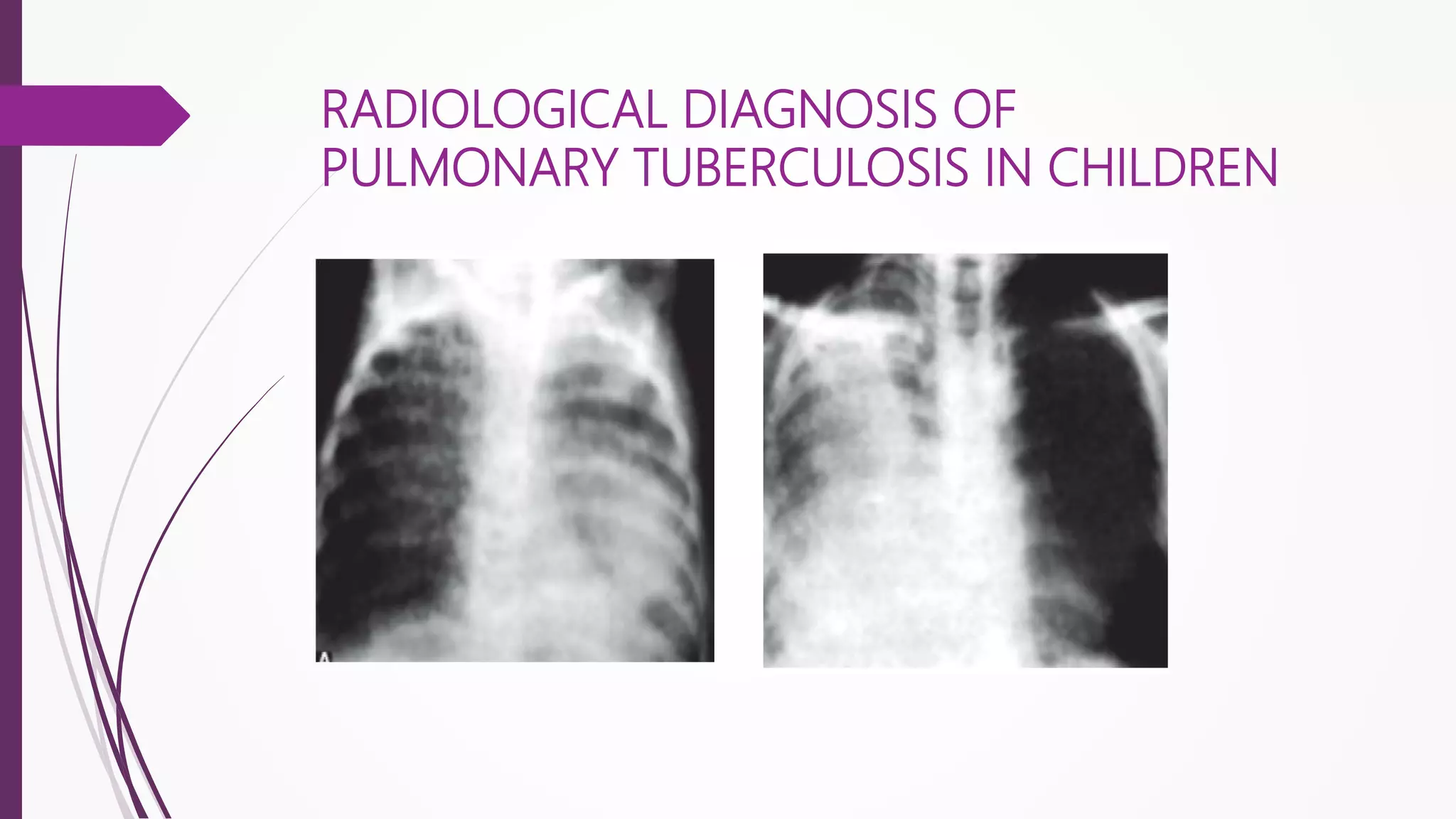 Radiological patterns, management of pediatric tb | PPT