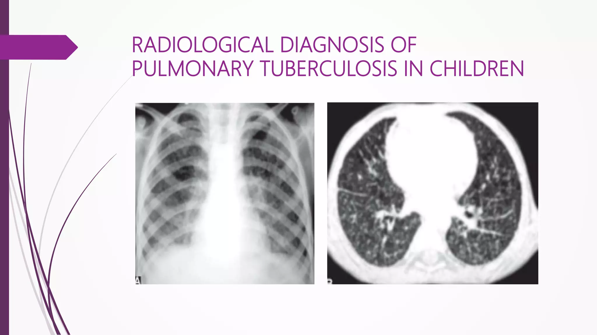 Radiological patterns, management of pediatric tb | PPT