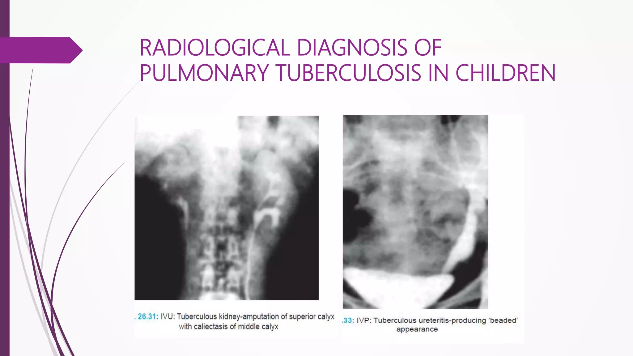 Radiological patterns, management of pediatric tb | PPT
