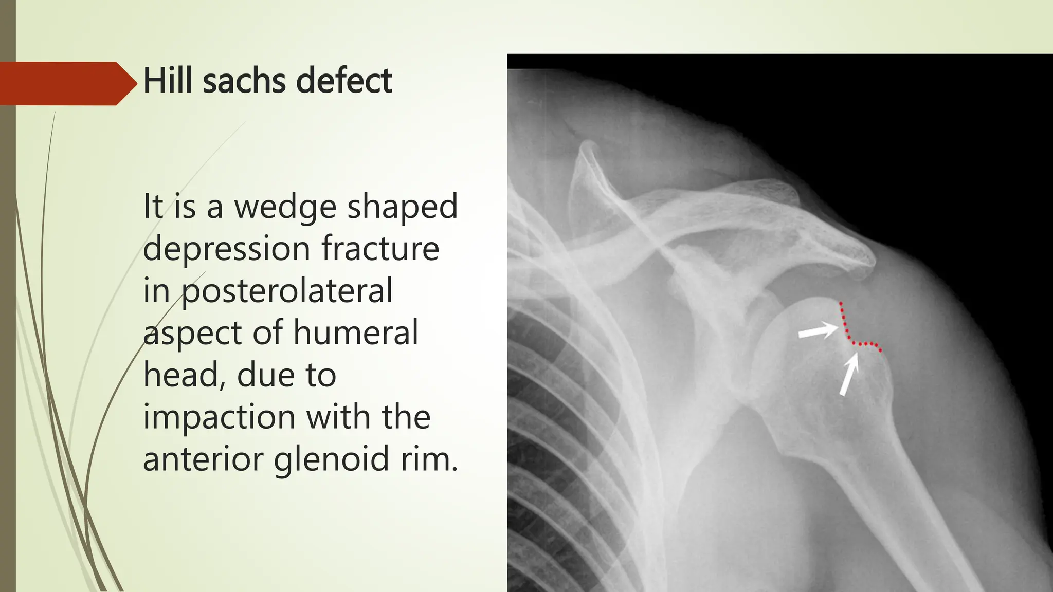 Radiological presentation fractures.pptx | Death, Injury, or Military ...