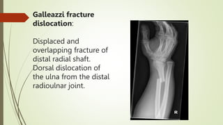 Radiological presentation fractures.pptx | Death, Injury, or Military ...