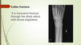 Radiological presentation fractures.pptx