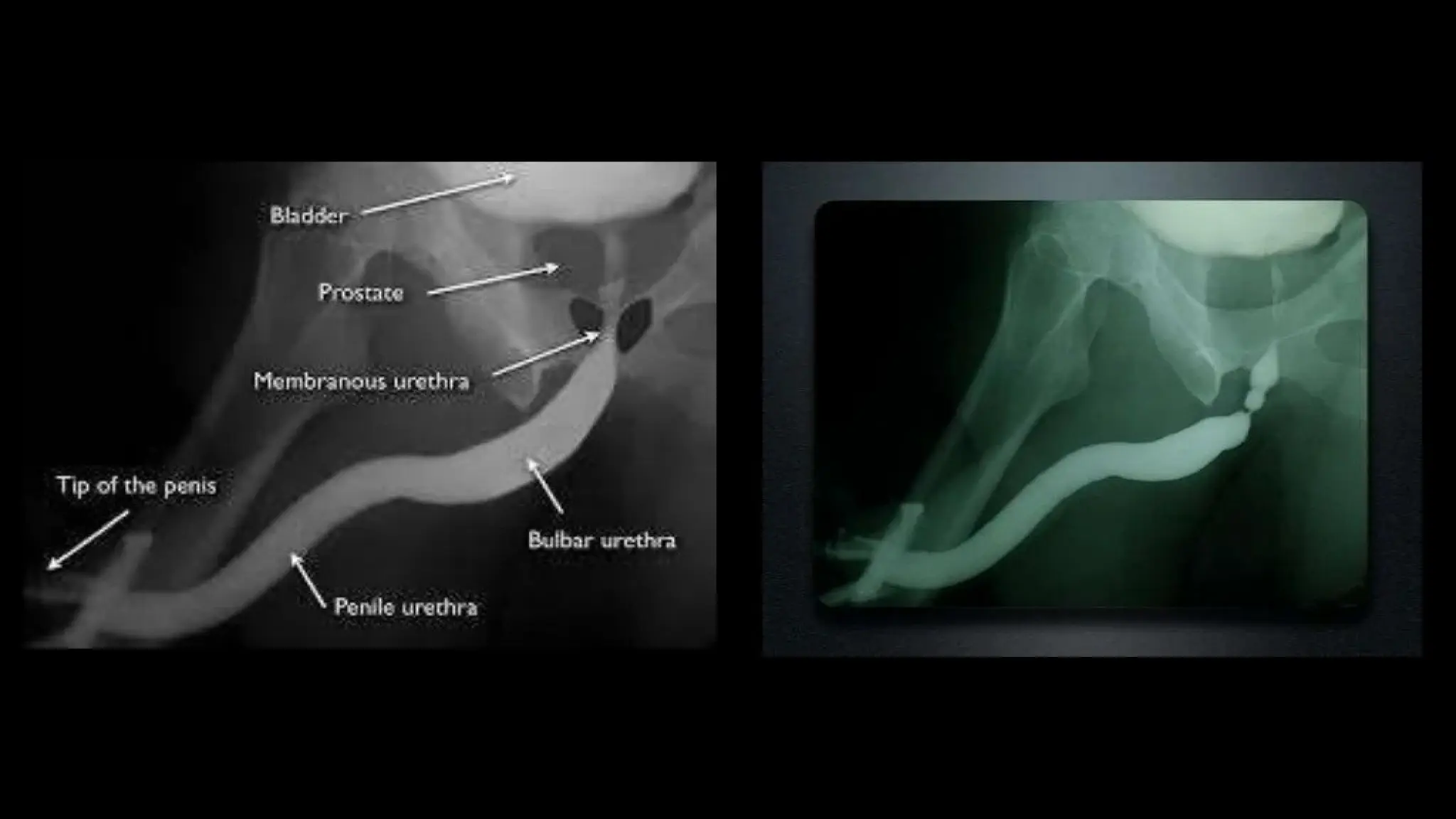 Radiological Procedure of Retrograde Urethrography.pptx