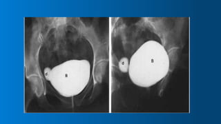 Radiological Procedure of Retrograde Urethrography.pptx
