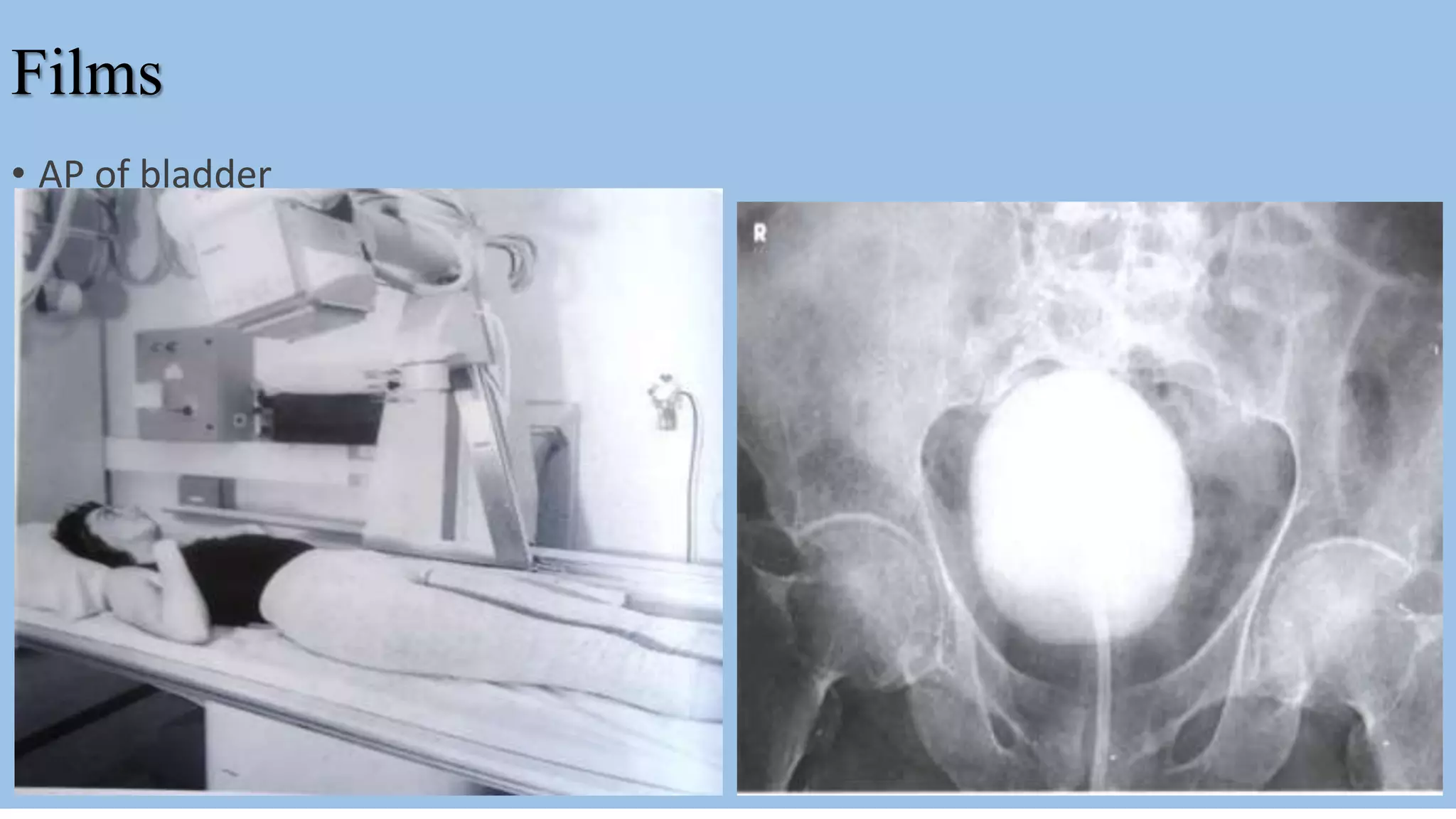 Radiological procedure of retrograde urethrography(rgu) and micturating ...