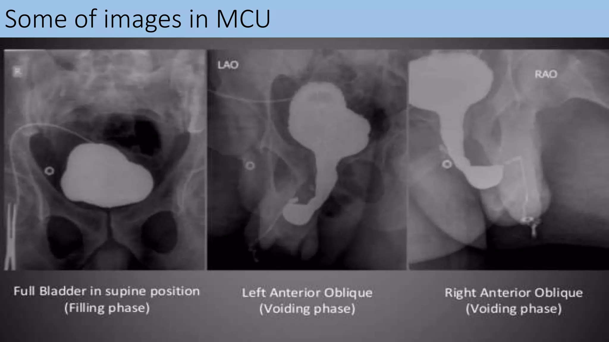Radiological procedure of retrograde urethrography(rgu) and micturating ...