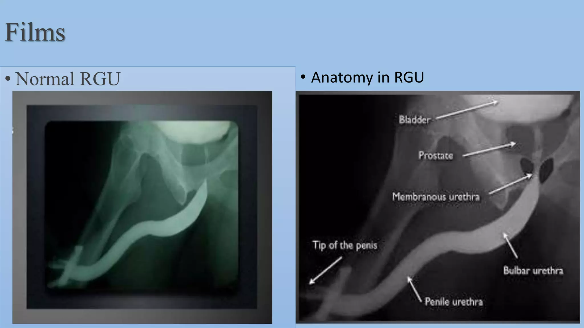 Radiological procedure of retrograde urethrography(rgu) and micturating ...