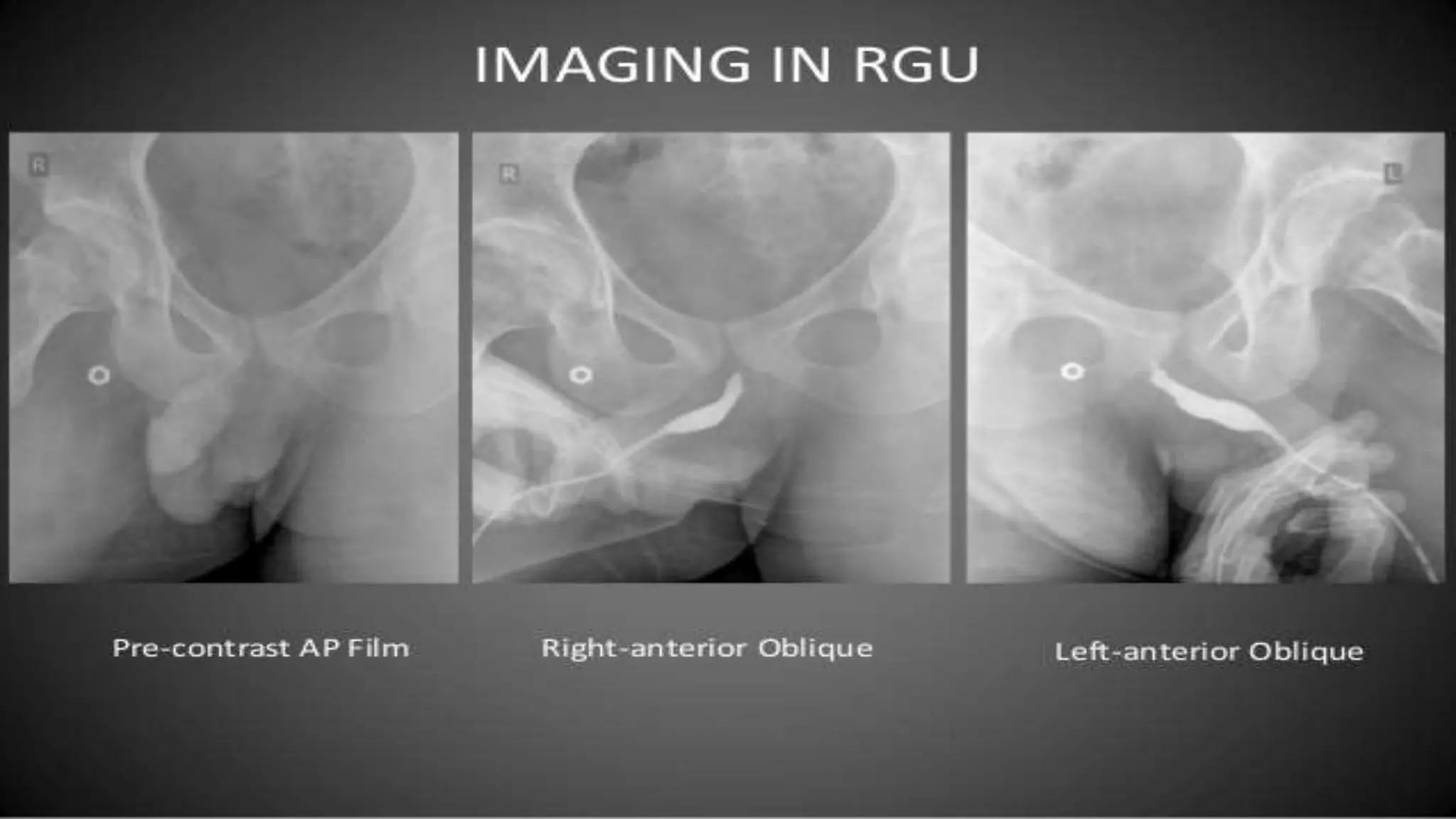 Radiological procedure of retrograde urethrography(rgu) and micturating | PPTX