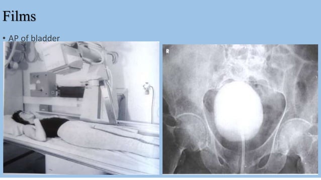 Radiological procedure of retrograde urethrography(rgu) and micturating ...
