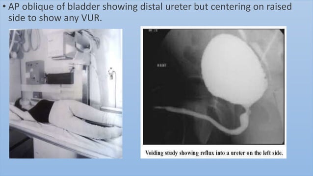 Radiological procedure of retrograde urethrography(rgu) and micturating ...