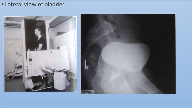 Radiological procedure of retrograde urethrography(rgu) and micturating ...