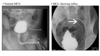 Radiological procedure of retrograde urethrography(rgu) and micturating ...