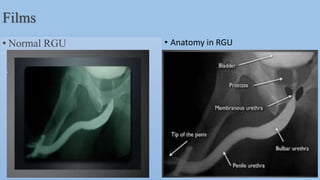 Radiological procedure of retrograde urethrography(rgu) and micturating ...