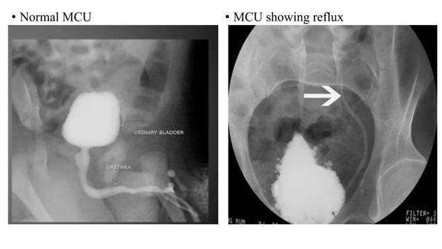 Radiological procedure of retrograde urethrography(rgu) and micturating