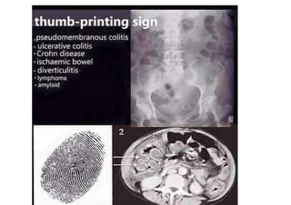 Radiological signs | PDF