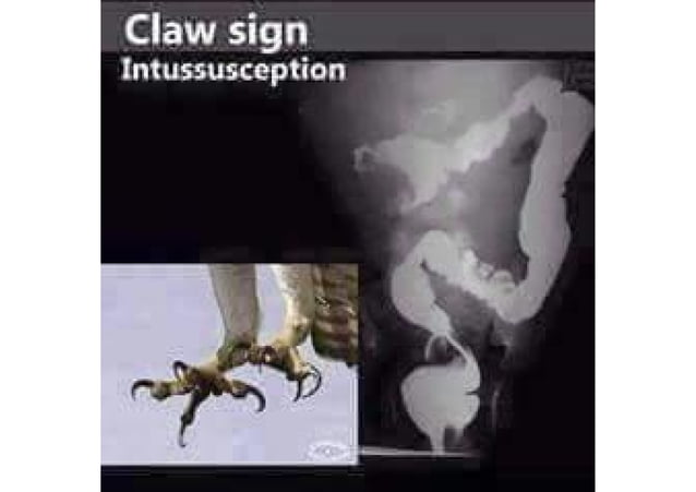 Radiological signs | PPT