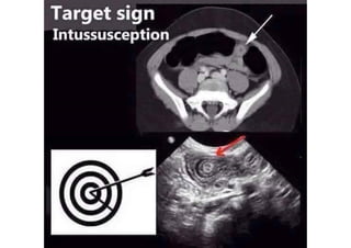 Radiological signs | PDF