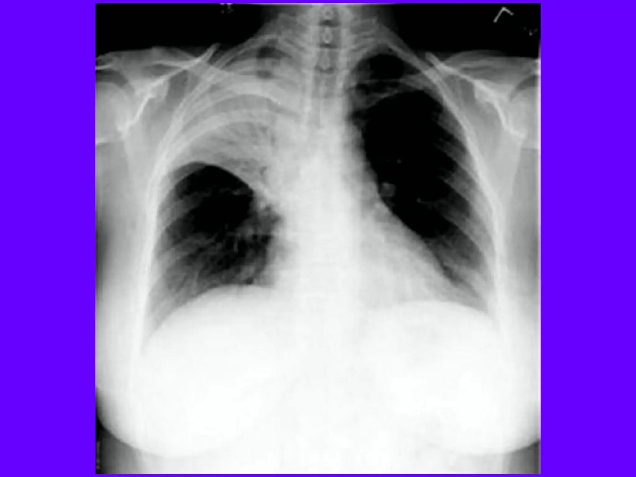 Radiological Signs in Chest Medicine | PPT