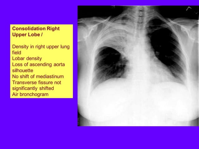 Radiological Signs in Chest Medicine | PPT