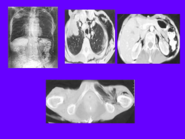 Radiological Signs in Chest Medicine | PPT