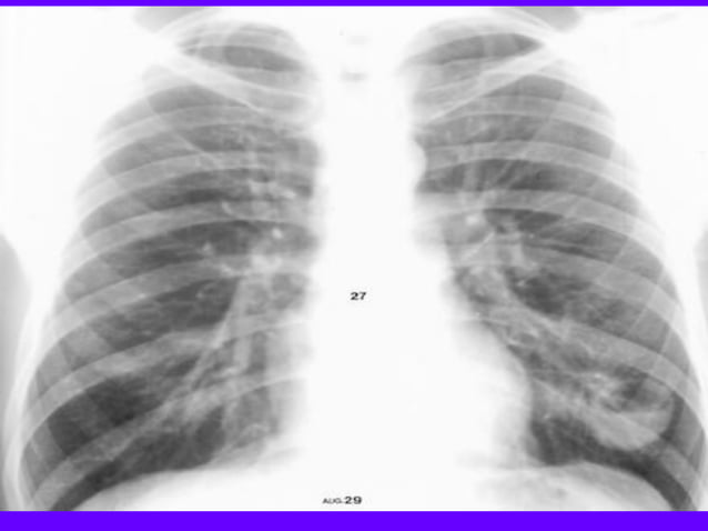 Radiological Signs in Chest Medicine | PPT