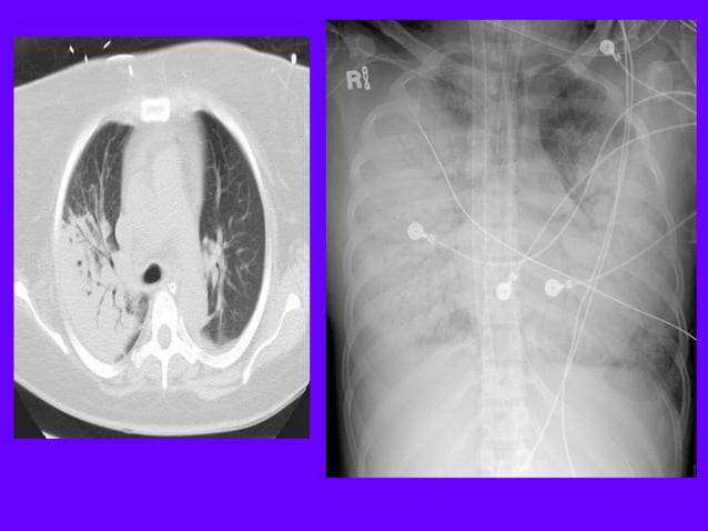 Radiological Signs in Chest Medicine | PPT