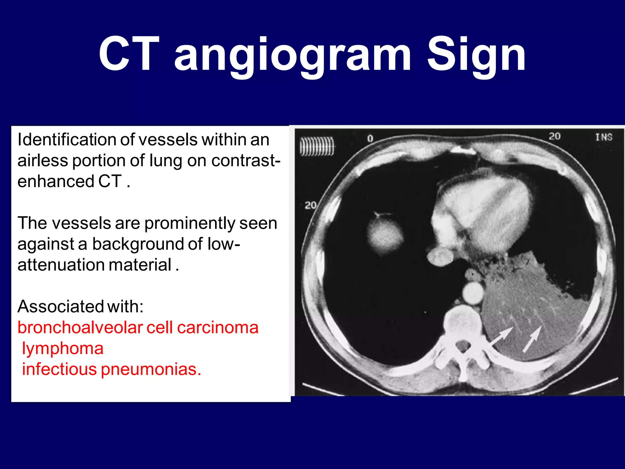 Radiological signs in chest medicine Part 1 | PDF