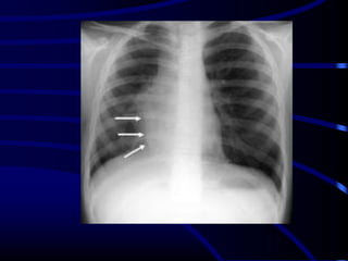 Radiological signs in chest medicine Part 1 | PDF