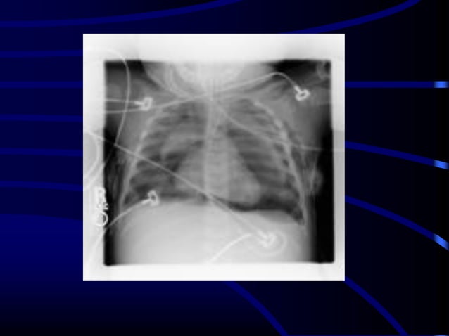 Radiological signs in chest medicine Part 1 | PDF