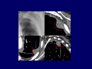 Radiological signs in chest medicine Part 1 | PDF