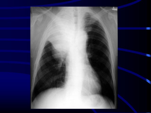 Radiological signs in chest medicine Part 1 | PDF