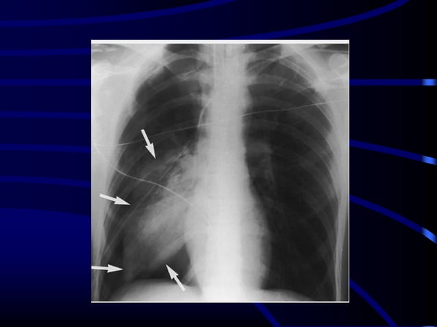 Radiological signs in chest medicine Part 1 | PDF