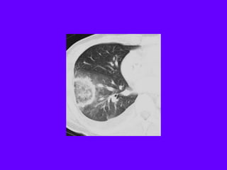 Radiological signs in chest medicine Part 1 | PDF