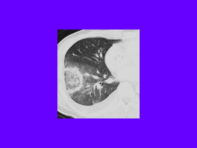 Radiological signs in chest medicine Part 1 | PDF