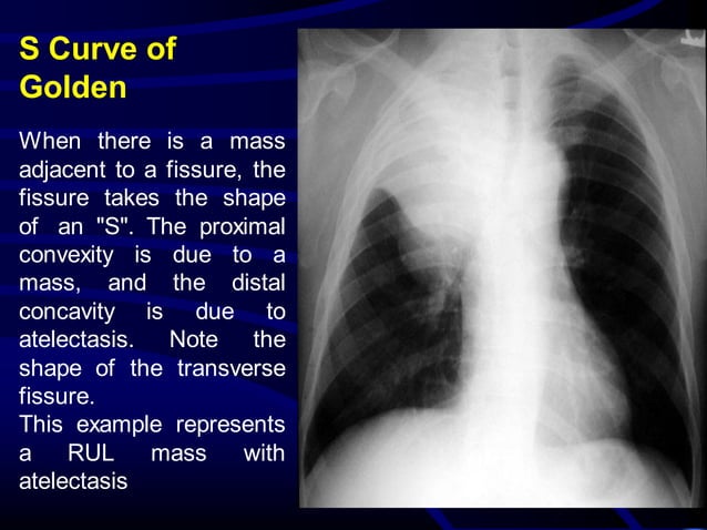 Radiological signs in chest medicine Part 1 | PDF