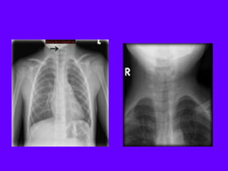 Radiological signs in chest medicine Part 1 | PDF