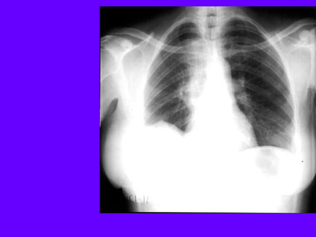 Radiological signs in chest medicine Part 1 | PDF