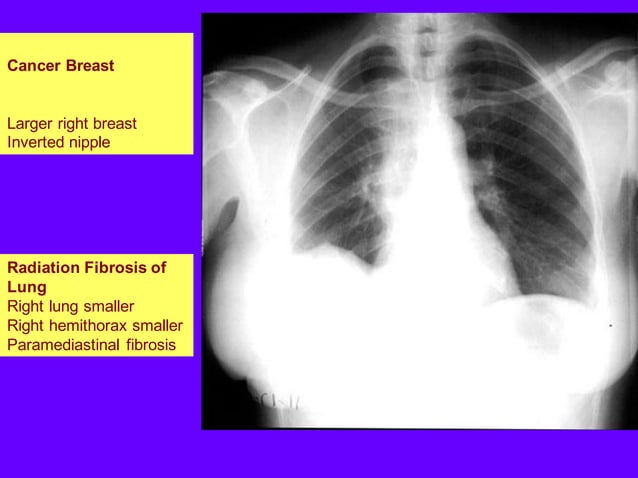 Radiological signs in chest medicine Part 1 | PDF
