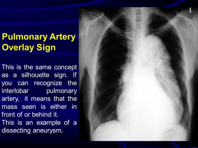 Radiological signs in chest medicine Part 1 | PDF